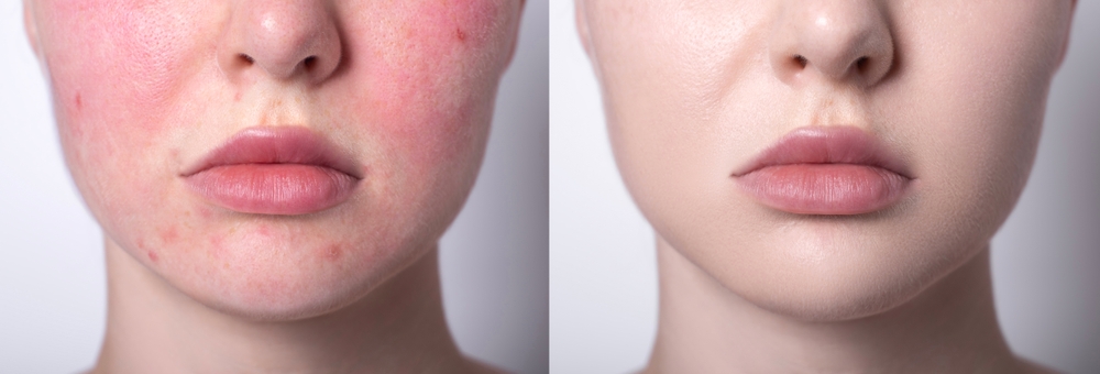 IPL Treatment for Rosacea in Albuquerque, NM